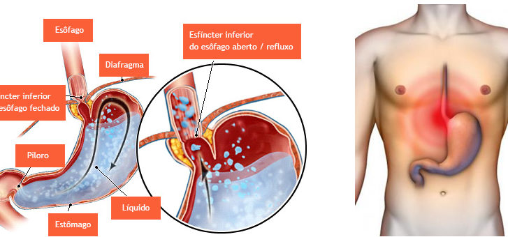 Doen a Do Refluxo Gastroesof gico DRGE Cl nica Do Aparelho