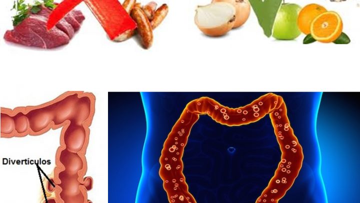 Diverticulite Colônica – Clínica do Aparelho Digestivo em Brasília ...