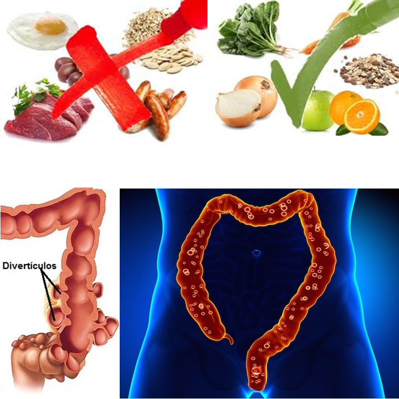 O Que E Diverticulose Colonica - NAZAEDU